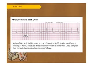 Basics of ECG | PDF