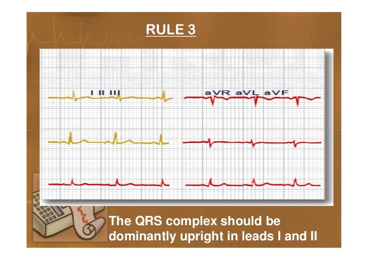 Basics of ECG