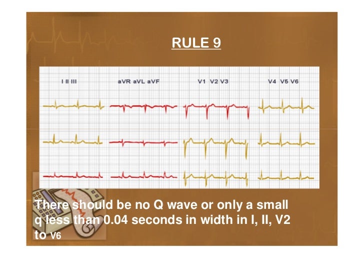 Basics of ECG