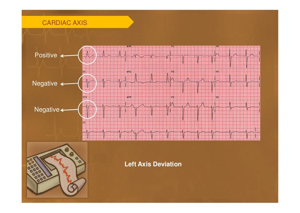 Detailed Components Of Ecg Chart