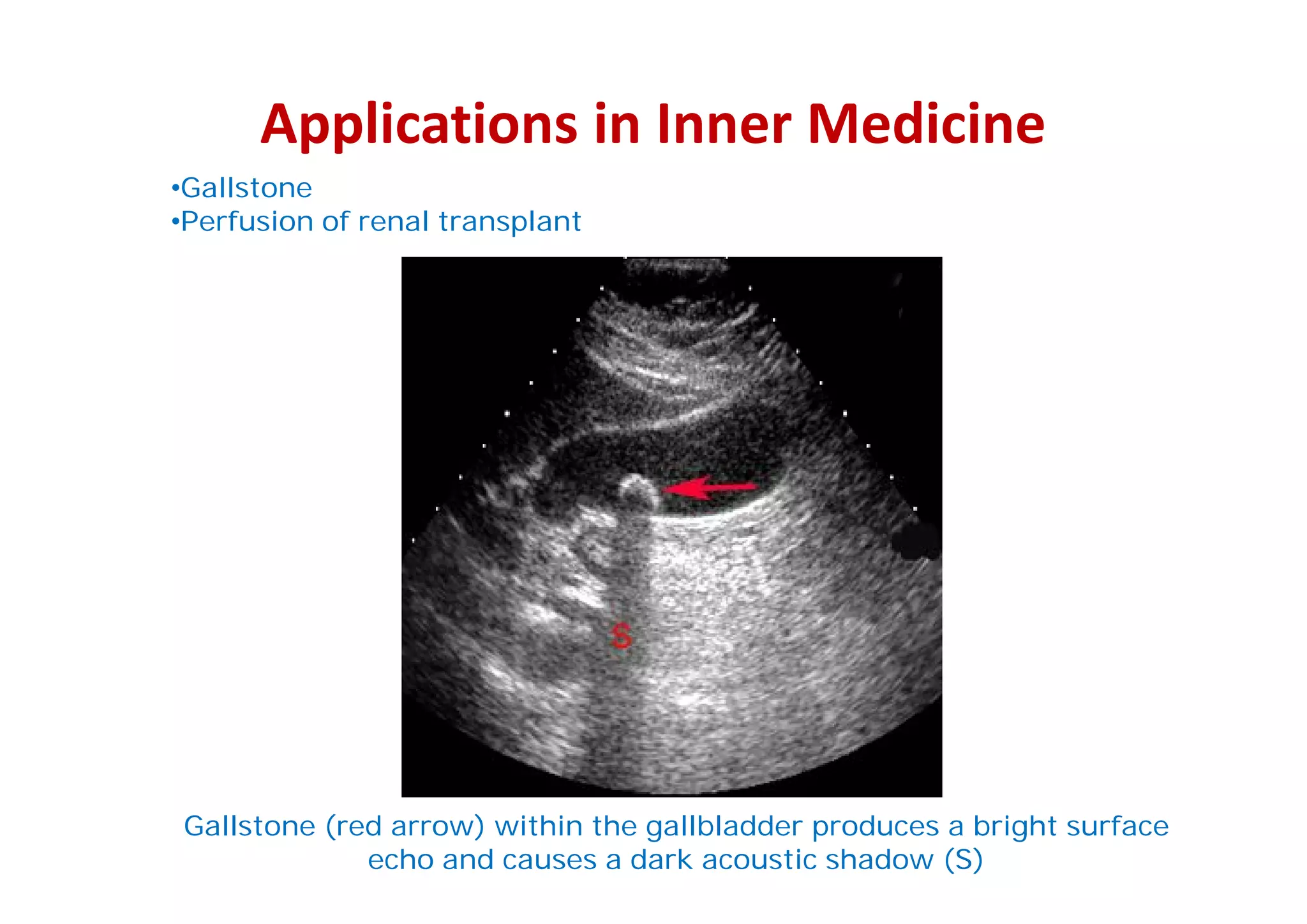 Basics of Ultrasound | PDF