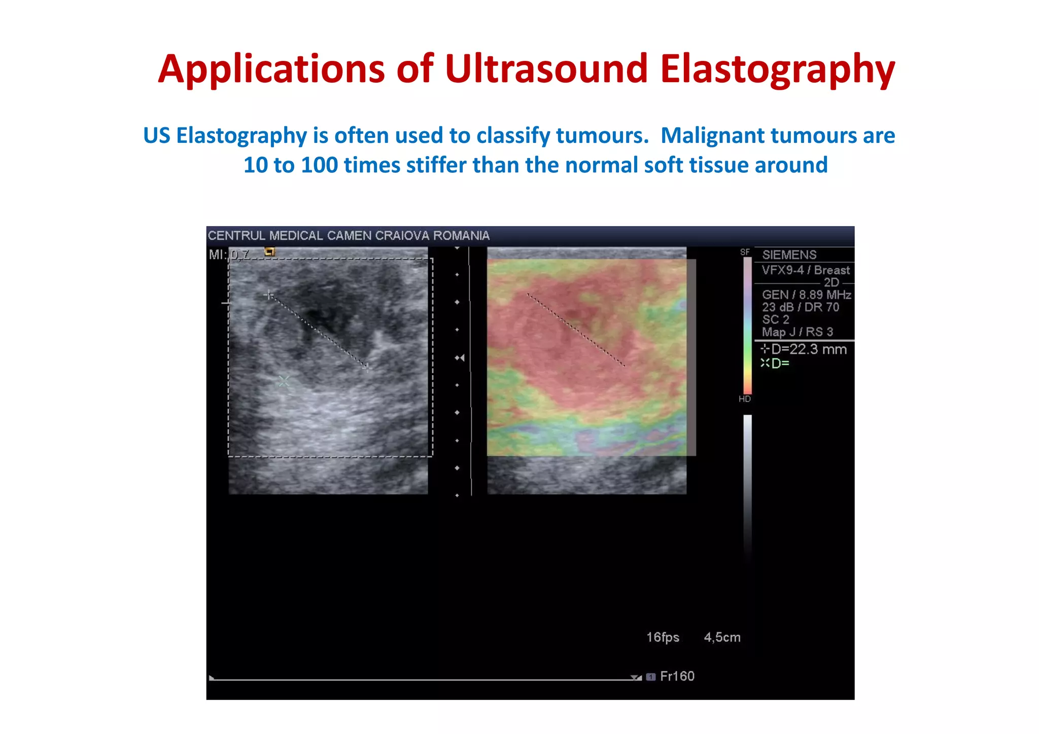 Basics of Ultrasound | PDF