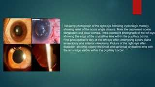 Microspherophakia | PPTX