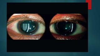 Microspherophakia | PPTX