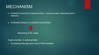 Microspherophakia | PPTX