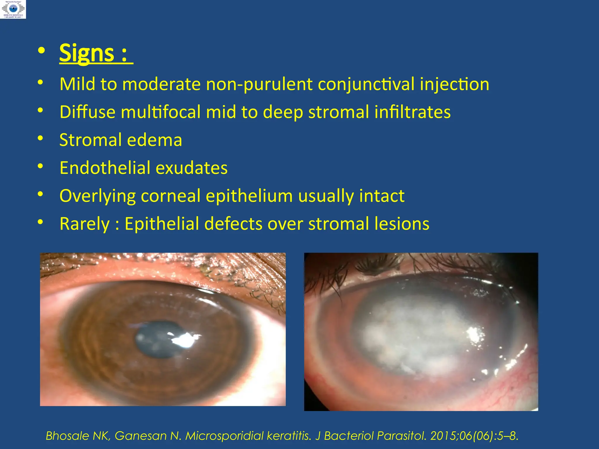 MICROSPORIDIAL KERATITIS , CLINICAL FEATURES , TREATMENT | PPTX