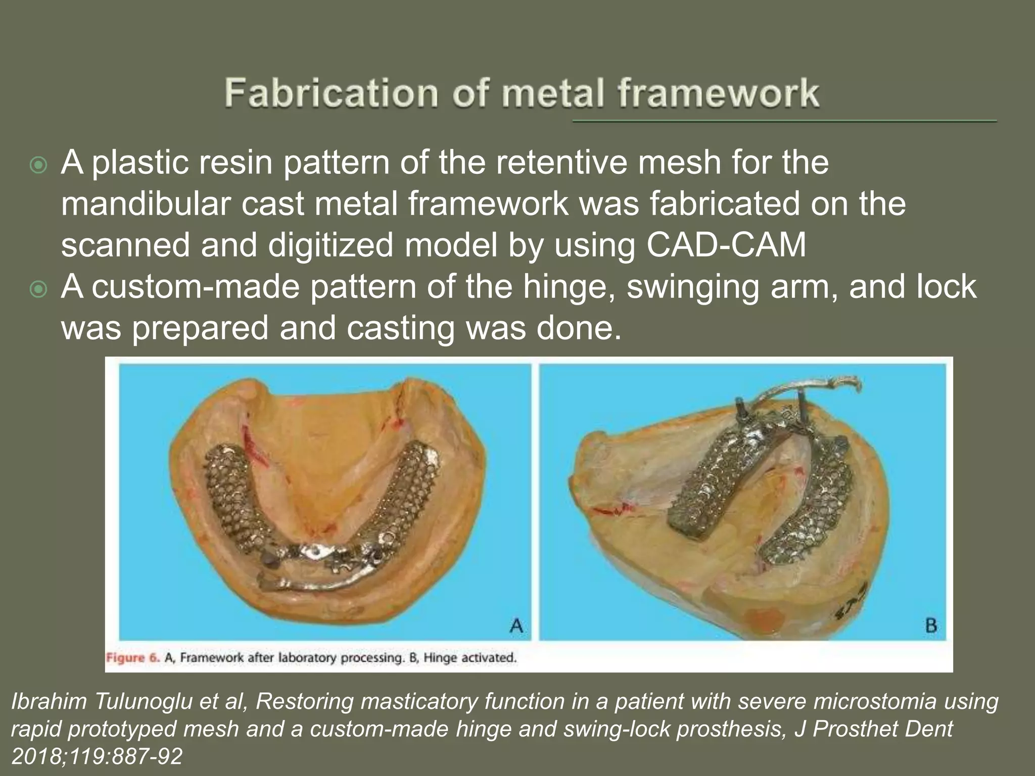 Microstomia- Prosthetic Managemnt of edentulous arches | PPTX