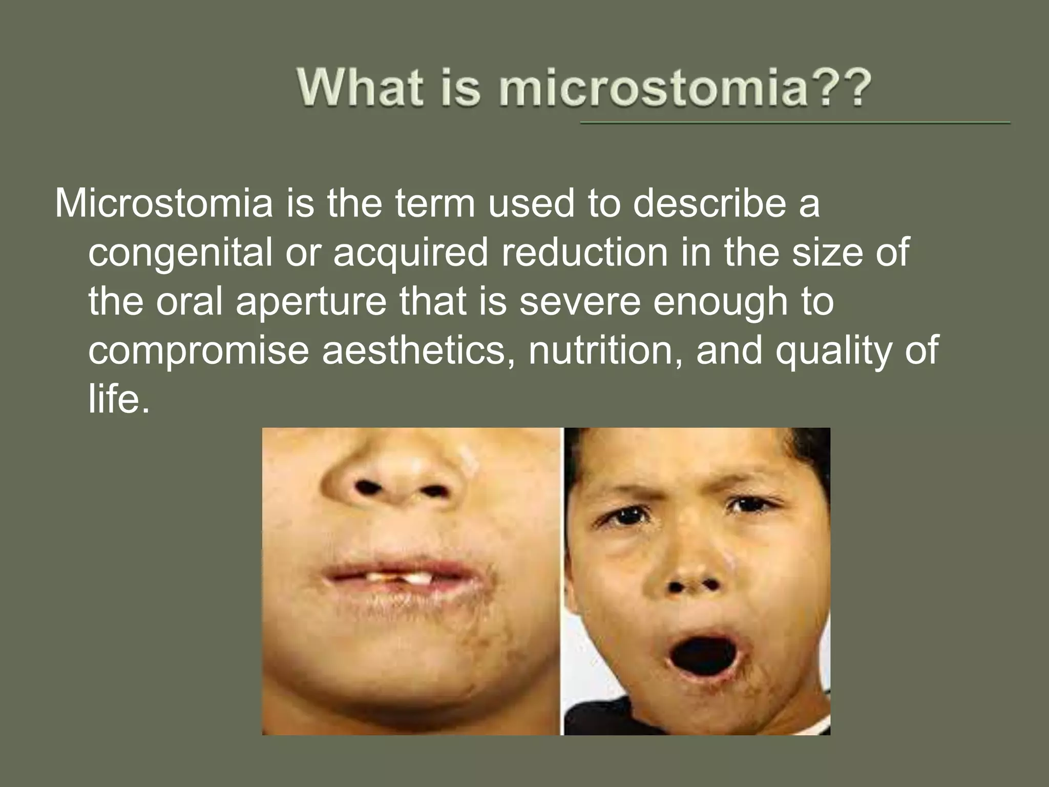 Microstomia- Prosthetic Managemnt of edentulous arches | PPTX