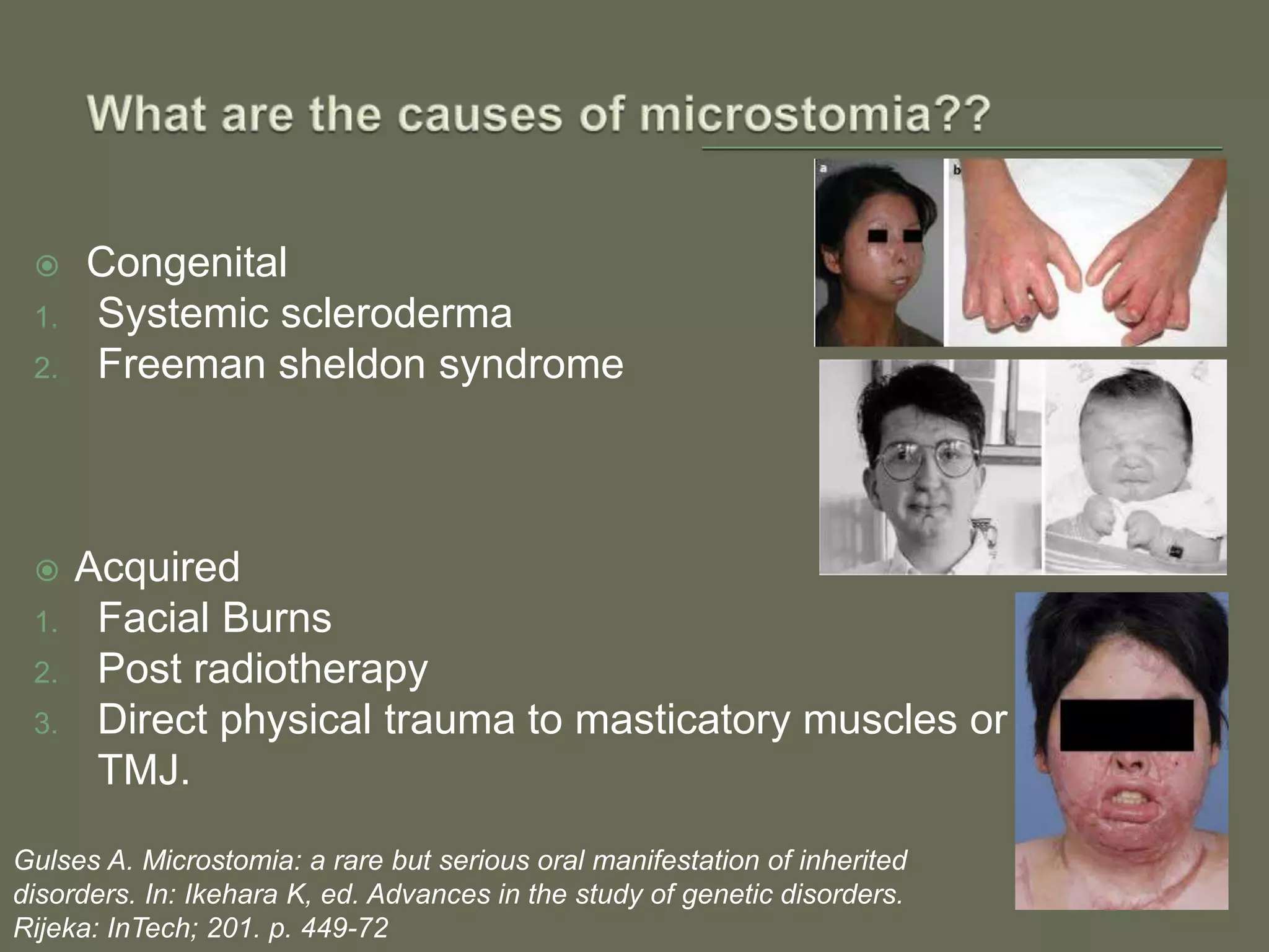 Microstomia- Prosthetic Managemnt of edentulous arches | PPTX