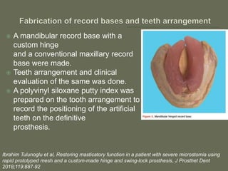 Microstomia- Prosthetic Managemnt of edentulous arches | PPTX