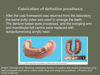Microstomia- Prosthetic Managemnt of edentulous arches | PPTX