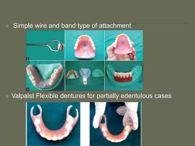 Microstomia- Prosthetic Managemnt of edentulous arches | PPTX