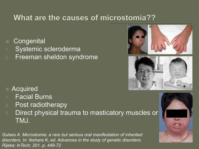 Microstomia- Prosthetic Managemnt of edentulous arches | PPTX
