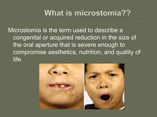 Microstomia- Prosthetic Managemnt of edentulous arches | PPT