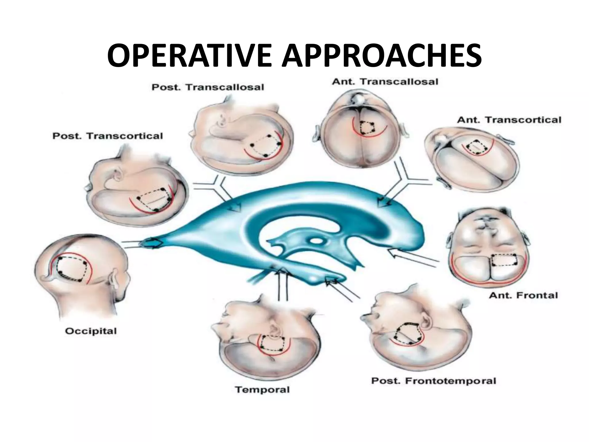 Microsurgical anatomy of lateral ventricles | PPTX