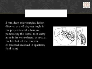 Microscissor DREZ- A new technical modification | PDF