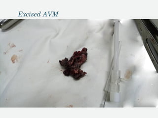 Microsurgical resection of large parieto occipital avm | PPT