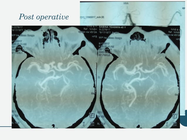 Microsurgical resection of large parieto occipital avm | PPT