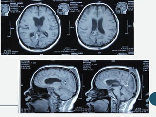 Microsurgical resection of large parieto occipital avm | PPT