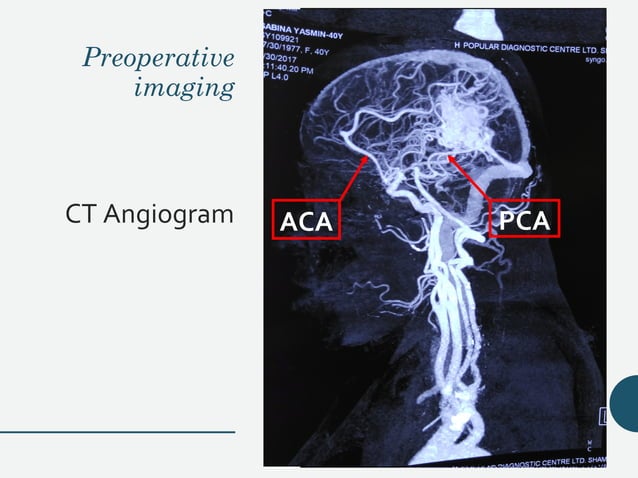 Microsurgical resection of large parieto occipital avm | PPT