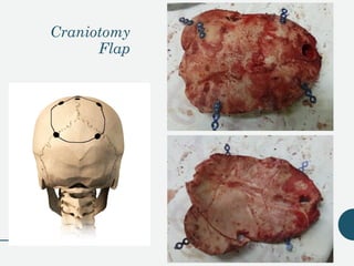 Microsurgical resection of large parieto occipital avm | PPT