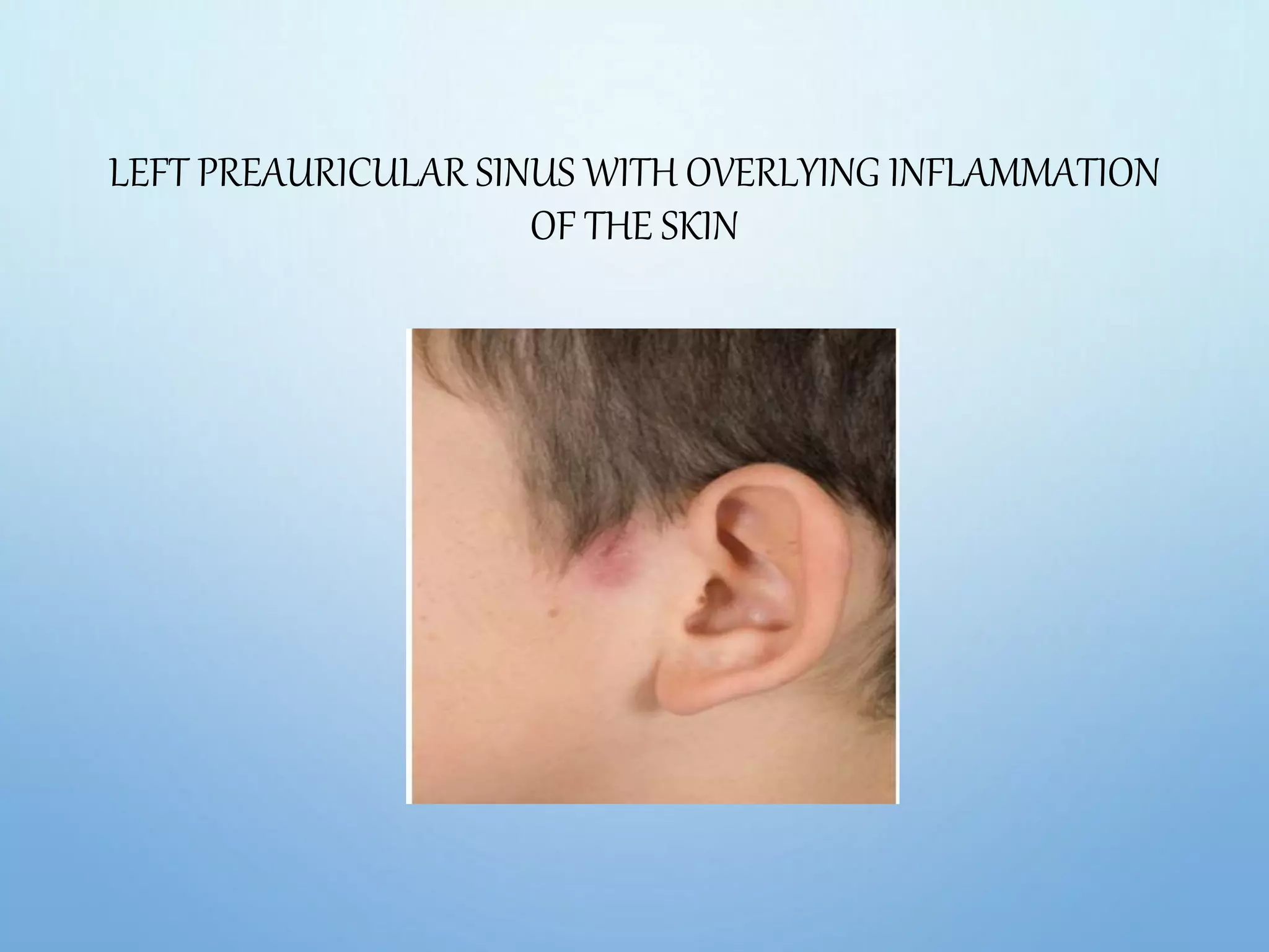 Microtia and ear abnormalities final | PPT