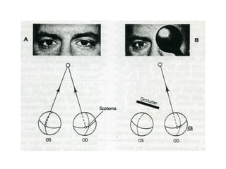 Microtropia - Definition, Types and Shot Note | PDF