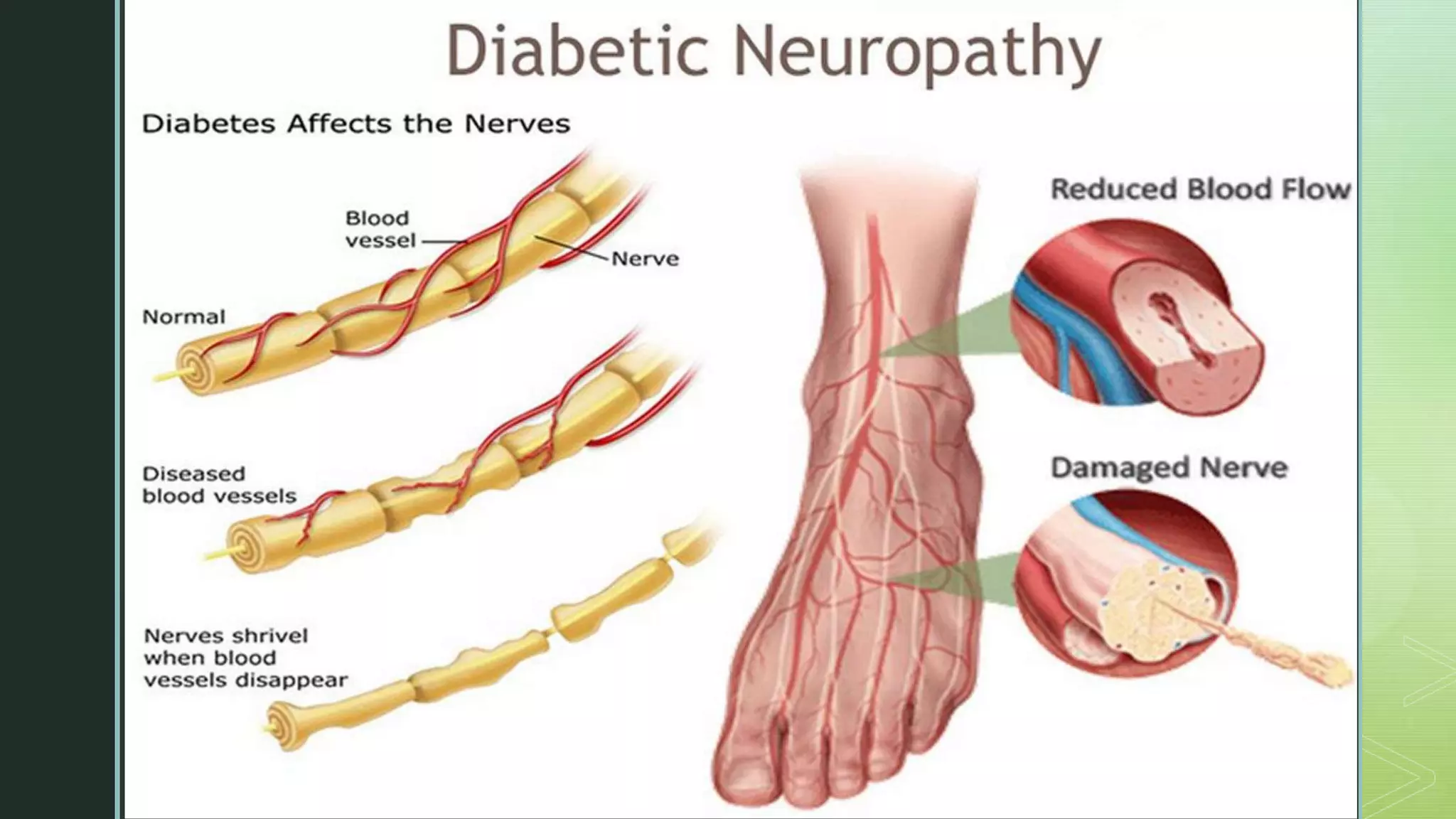 Microvascular Complications Of Diabetes Endocrinology Pptx