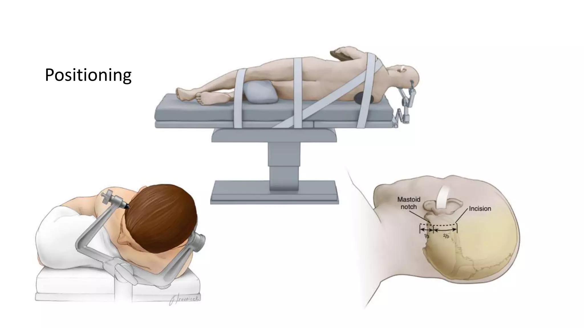 Microvascular Decompression.pptx