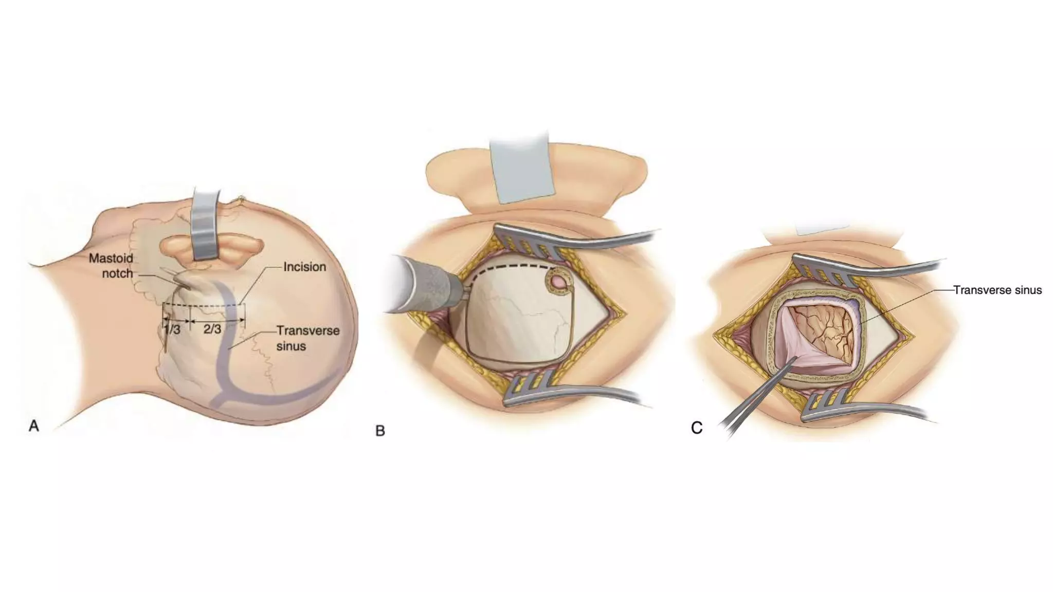 Microvascular Decompression.pptx