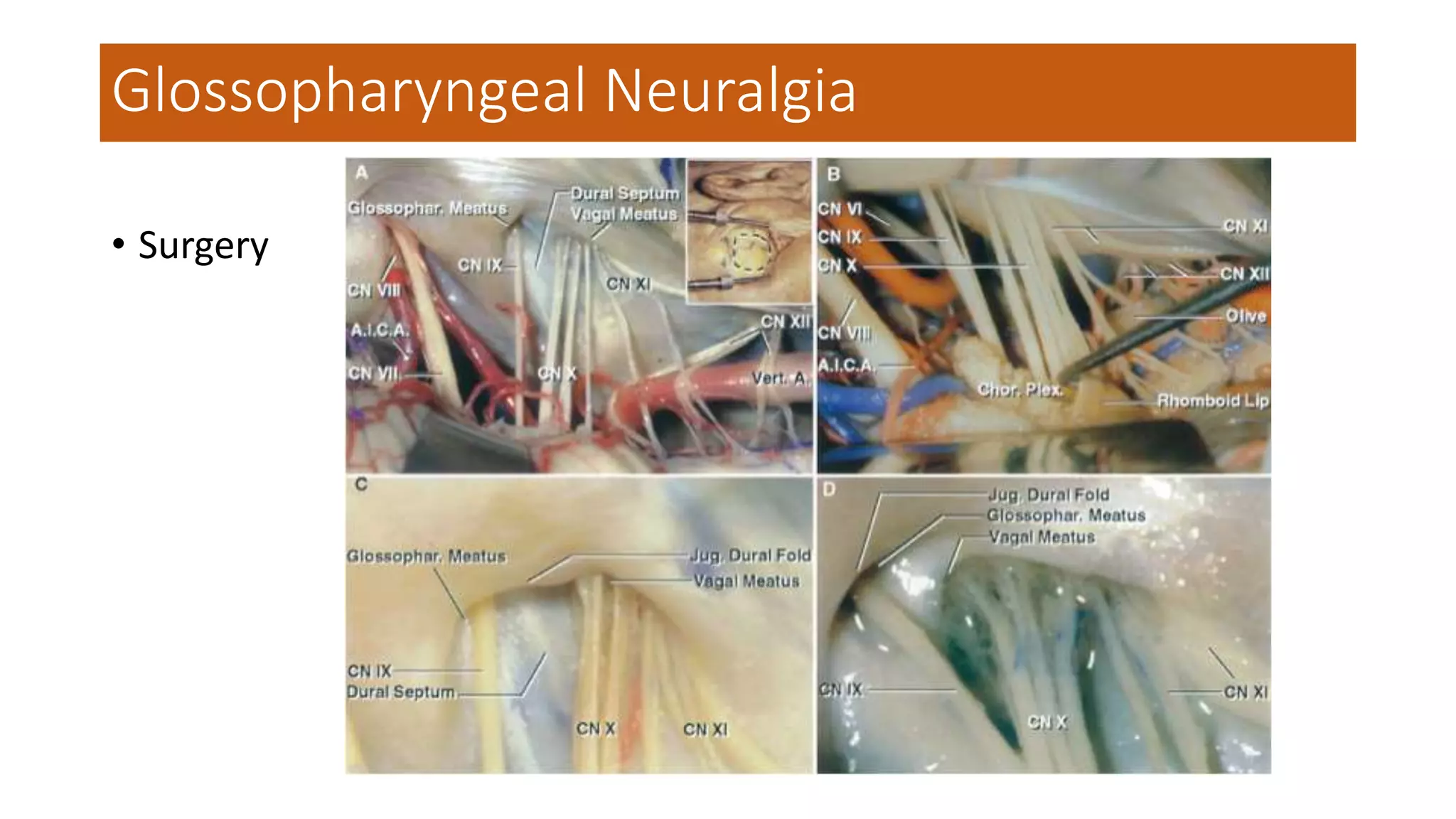 Microvascular Decompression.pptx