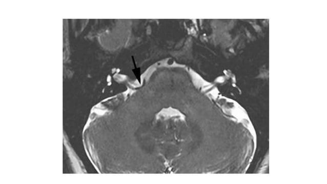 Microvascular Decompression.pptx
