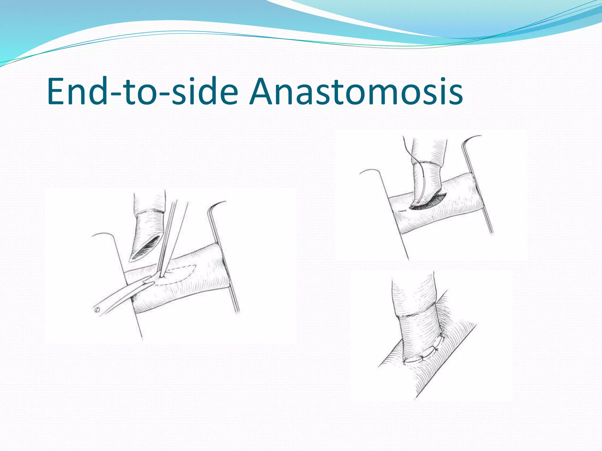 Microvascular flaps for reconstruction in head and neck cancer | PPTX
