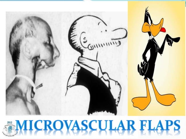 Microvascular flaps for reconstruction in head and neck cancer | PPTX ...