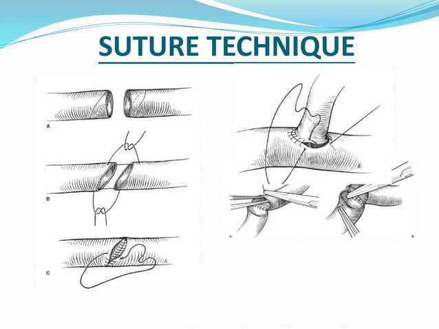 Microvascular flaps for reconstruction in head and neck cancer | PPT