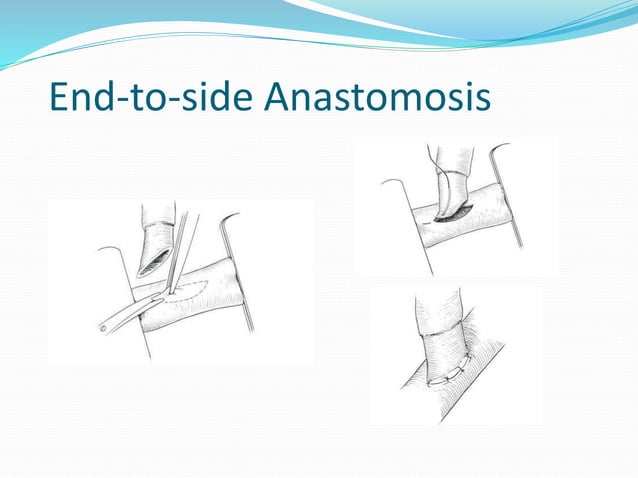 Microvascular flaps for reconstruction in head and neck cancer | PPTX ...