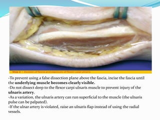 Microvascular flaps for reconstruction in head and neck cancer | PPTX
