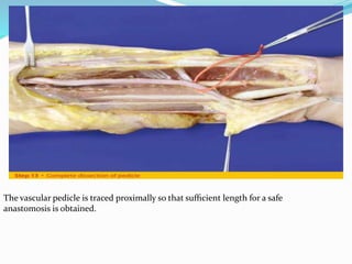 Microvascular flaps for reconstruction in head and neck cancer | PPTX
