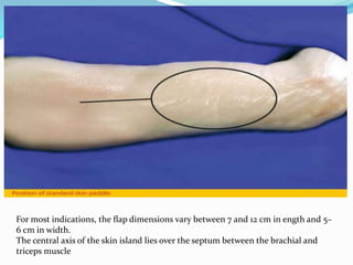Microvascular flaps for reconstruction in head and neck cancer | PPTX