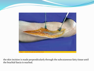 Microvascular flaps for reconstruction in head and neck cancer | PPTX