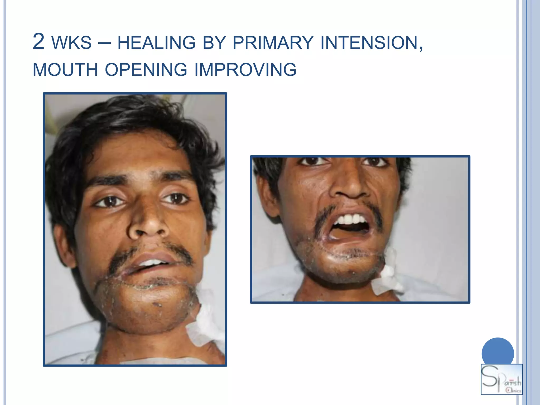 Microvascular transfer of fibula for mandibular reconstruction | PPTX