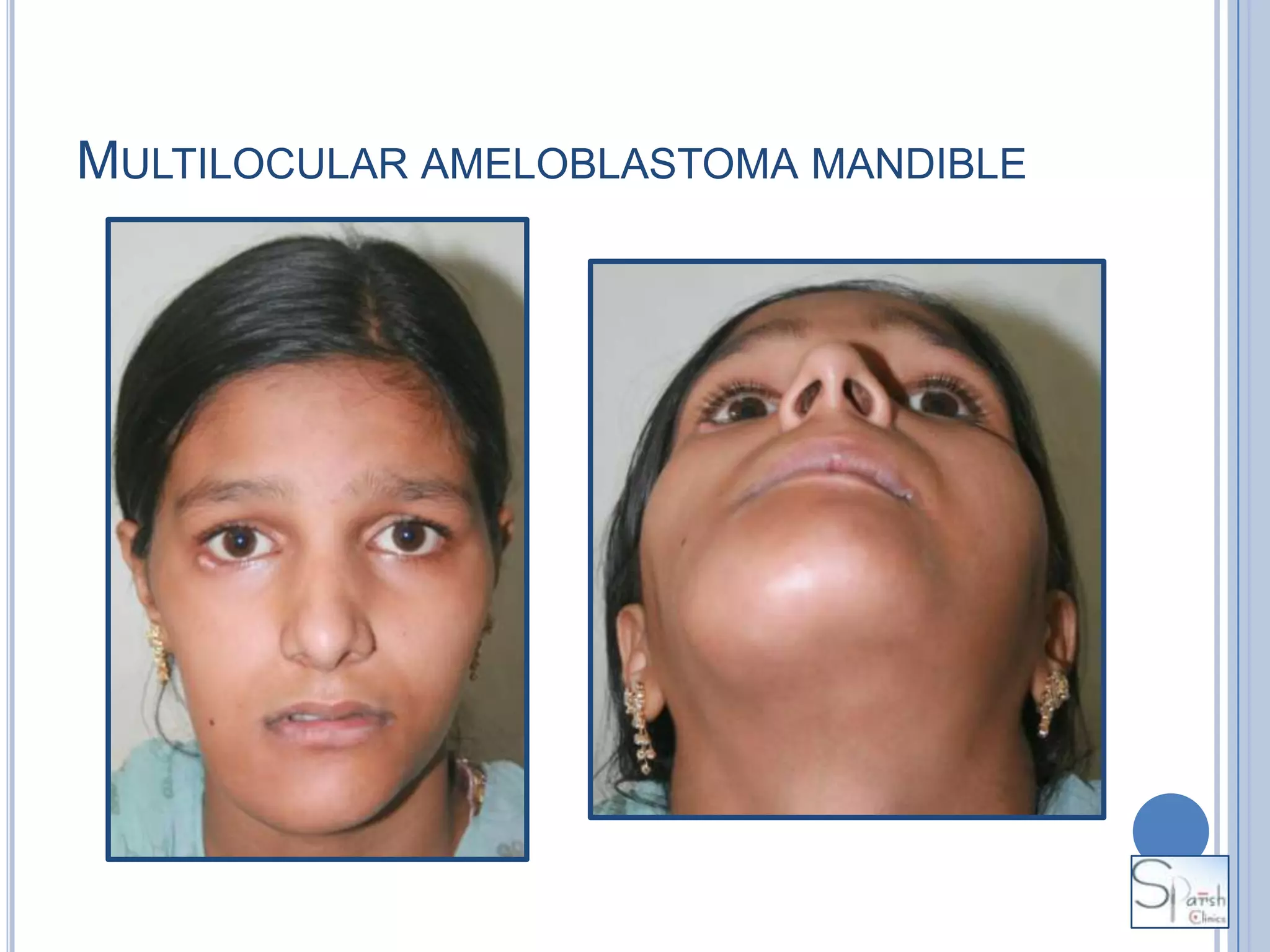 Microvascular transfer of fibula for mandibular reconstruction | PPTX