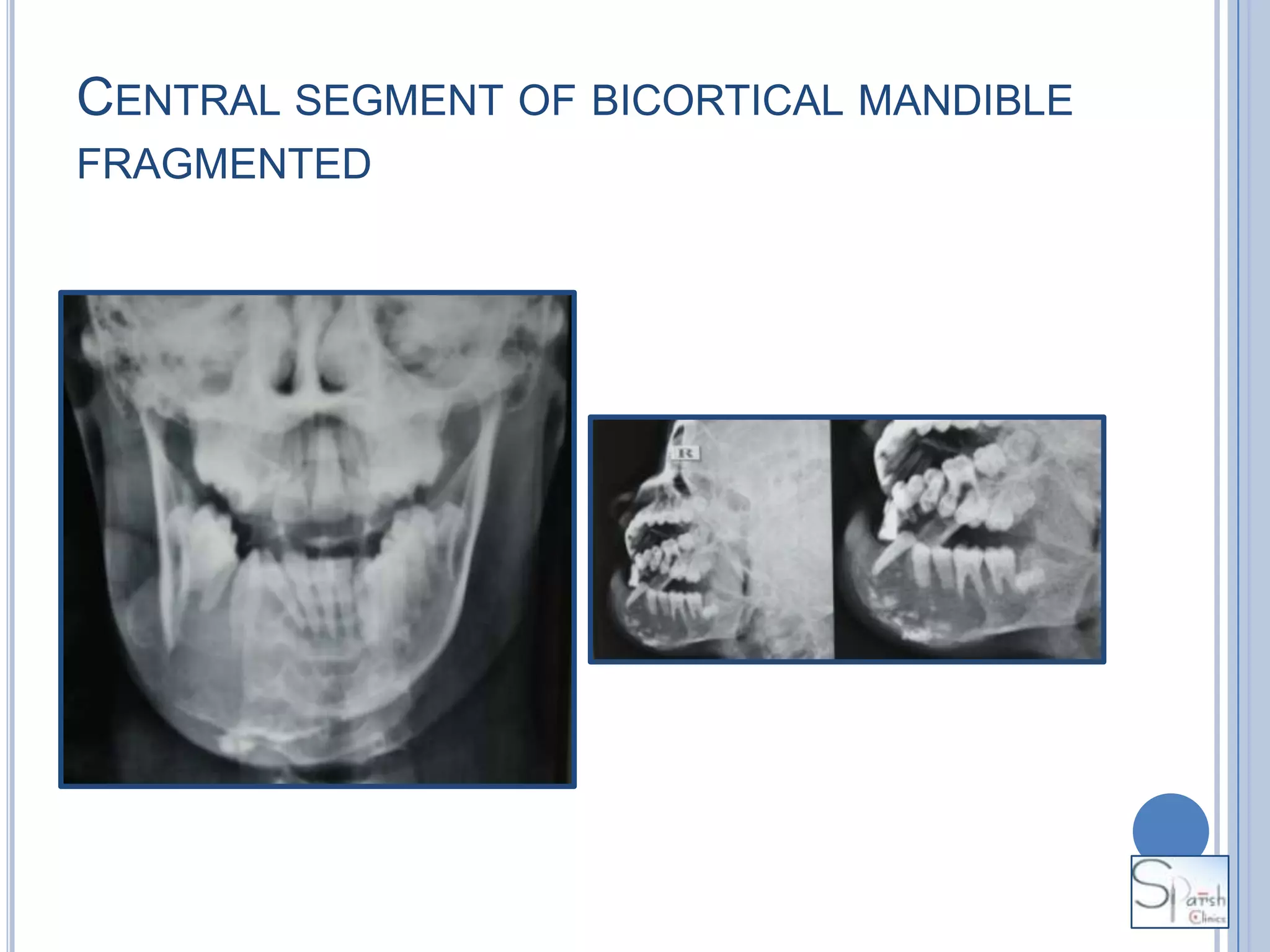 Microvascular transfer of fibula for mandibular reconstruction | PPTX