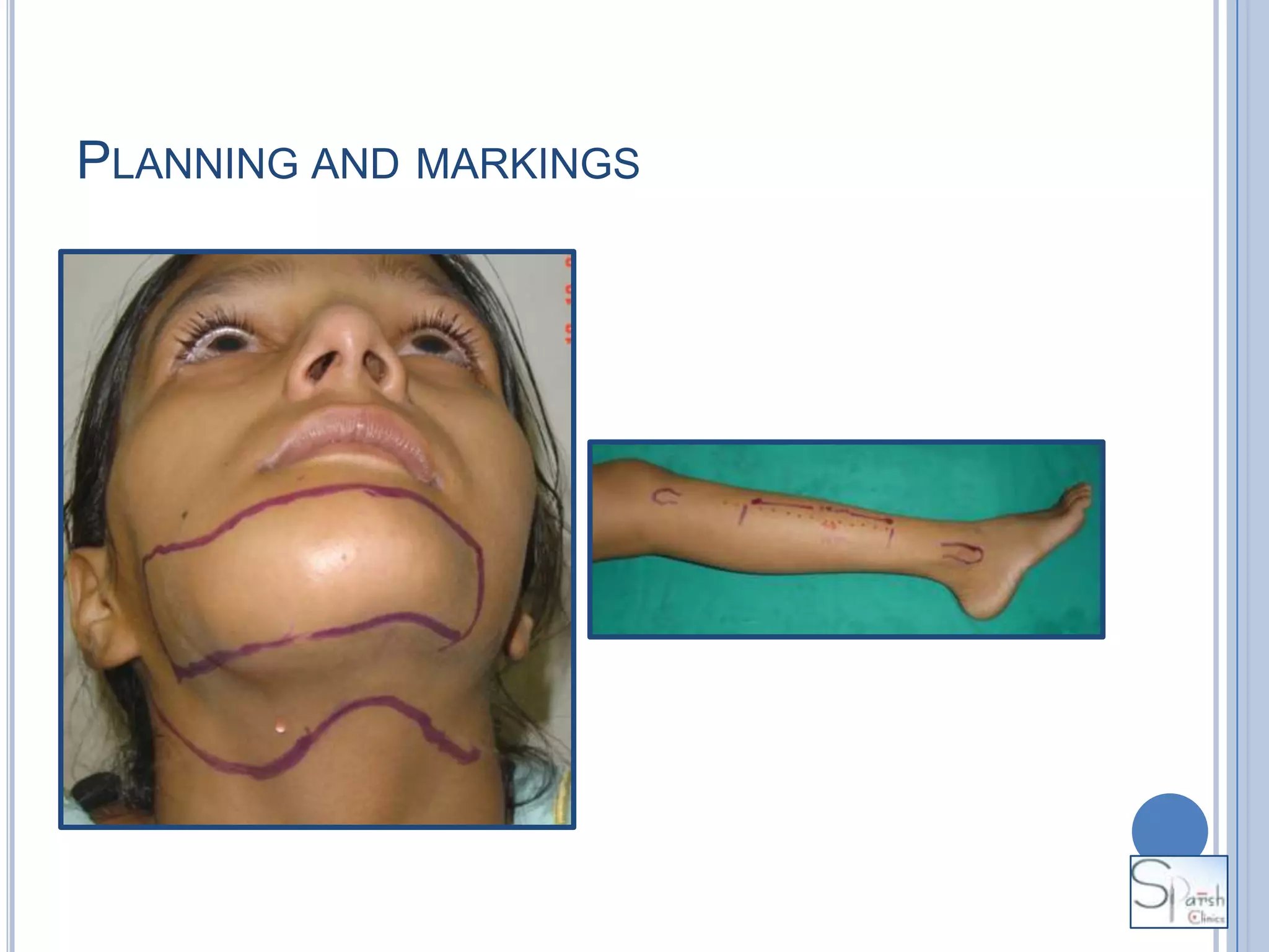 Microvascular transfer of fibula for mandibular reconstruction | PPTX