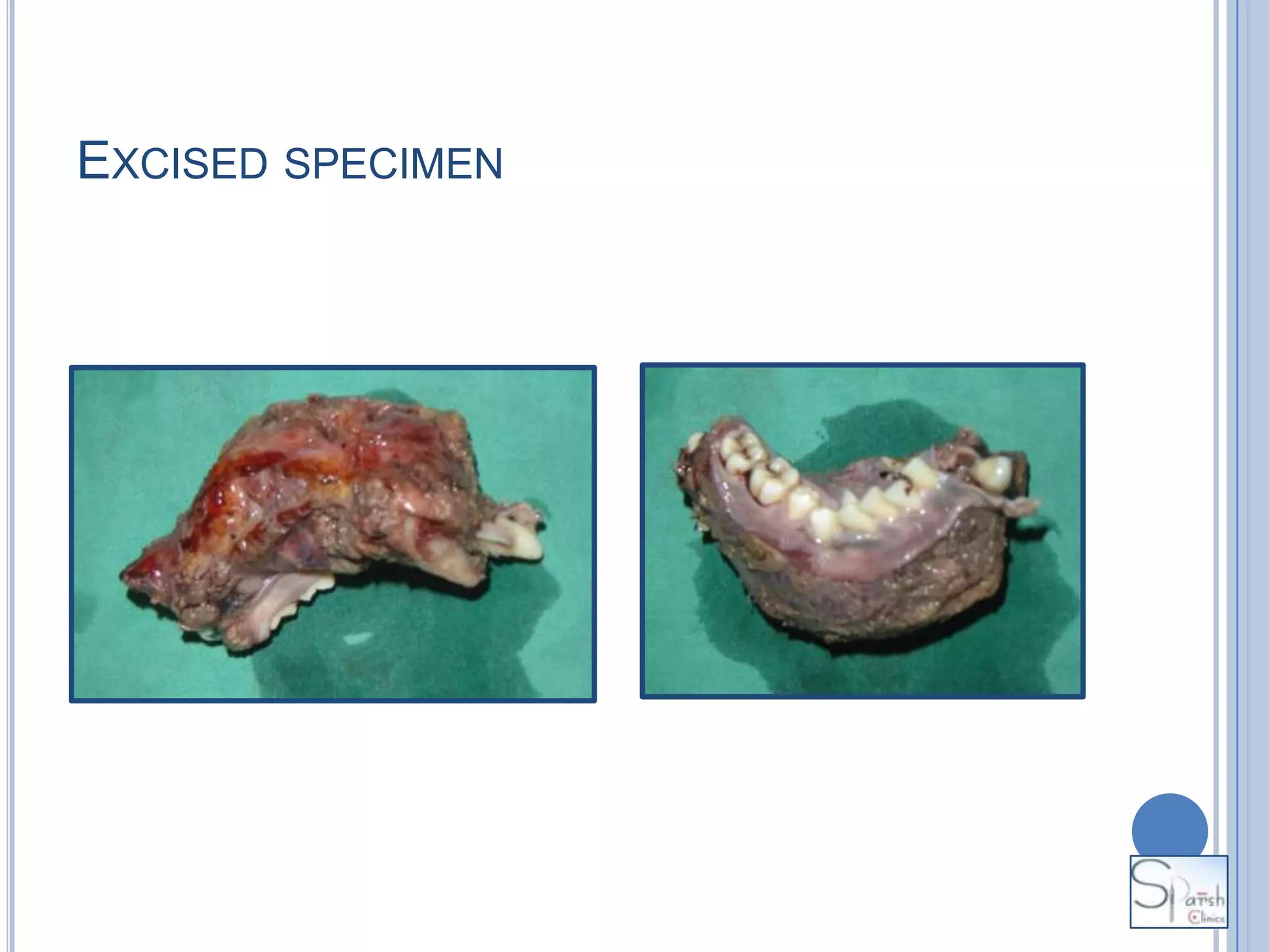 Microvascular transfer of fibula for mandibular reconstruction | PPTX