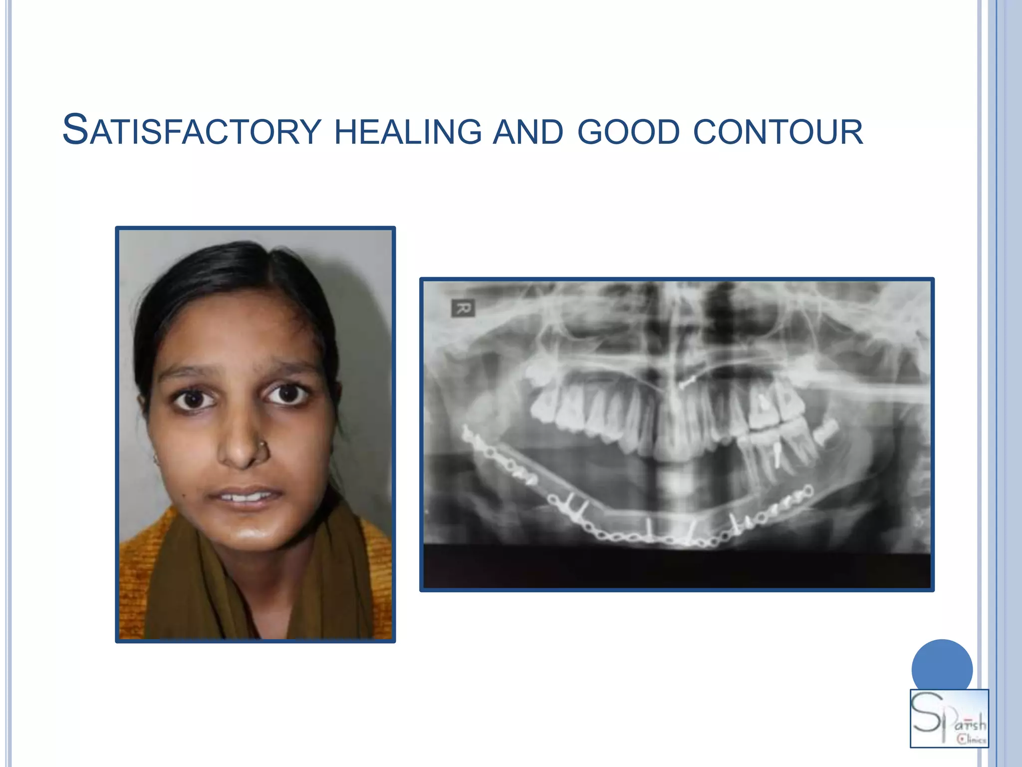 Microvascular transfer of fibula for mandibular reconstruction | PPTX