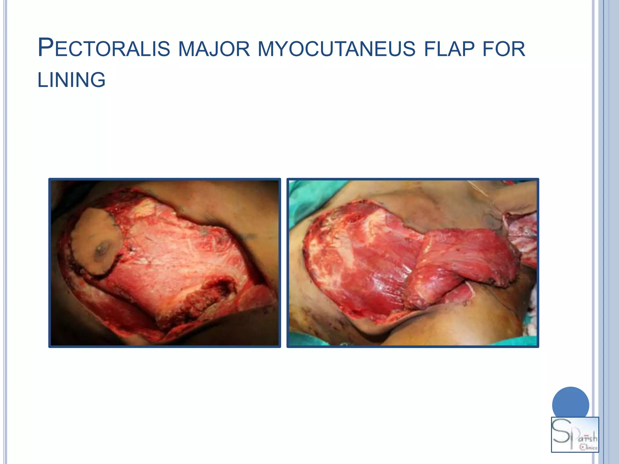 Microvascular transfer of fibula for mandibular reconstruction | PPT