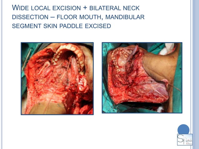 Microvascular transfer of fibula for mandibular reconstruction | PPT