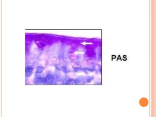 Microvillous inclusion disease (microvillous atrophy) | PPTX