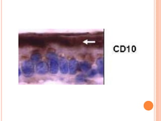 Microvillous inclusion disease (microvillous atrophy) | PPTX